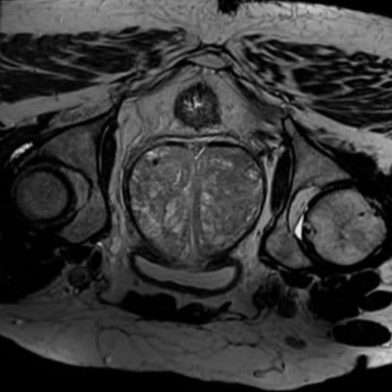 Resonancia Magnética Multiparamétrica de Próstata - Grupo VIVO